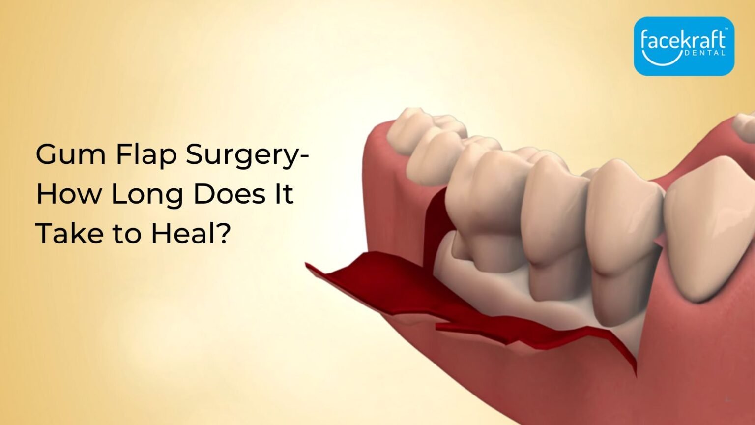 Gum Flap Surgery- How Long Does It Take to Heal? | FaceKraft Dental Implant Clinic