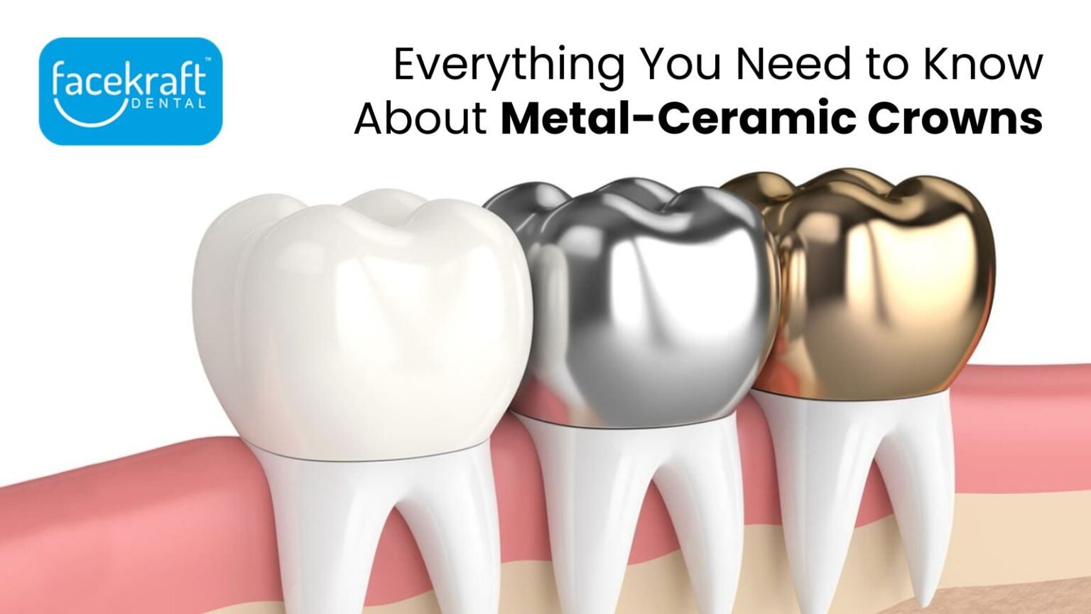 Everything You Need to Know About Metal-Ceramic Crowns - Facekraft ...
