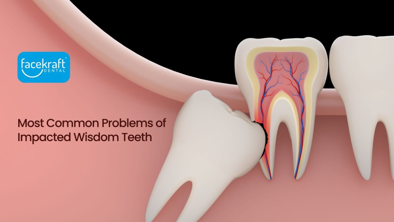 Most Common Problems of Impacted Wisdom Teeth | FaceKraft Dental ...